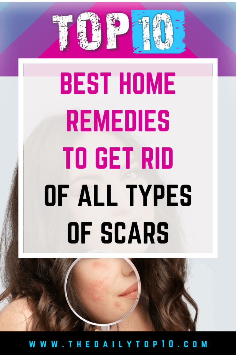 Top 10 Best Home Remedies to Get Rid of All Types of Scars